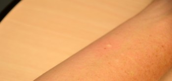 7.3 Intradermal and Subcutaneous Injections – Clinical Procedures for ...