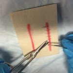 4.4 Suture Removal – Clinical Procedures for Safer Patient Care