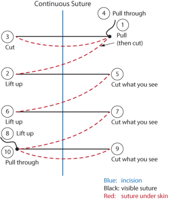 4.4 Suture Removal – Clinical Procedures for Safer Patient Care