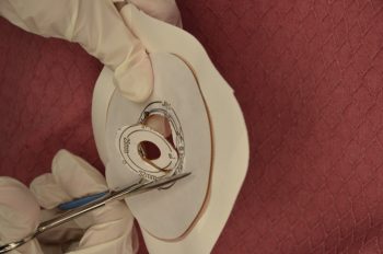 7.5 Ostomies – Personal Care Skills for Health Care Assistants